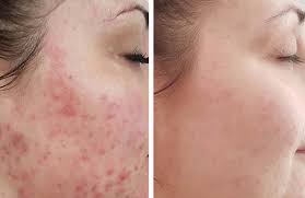 dermatologist doctors In Phursungi, Hadapsar, Manjari | hair loss ...