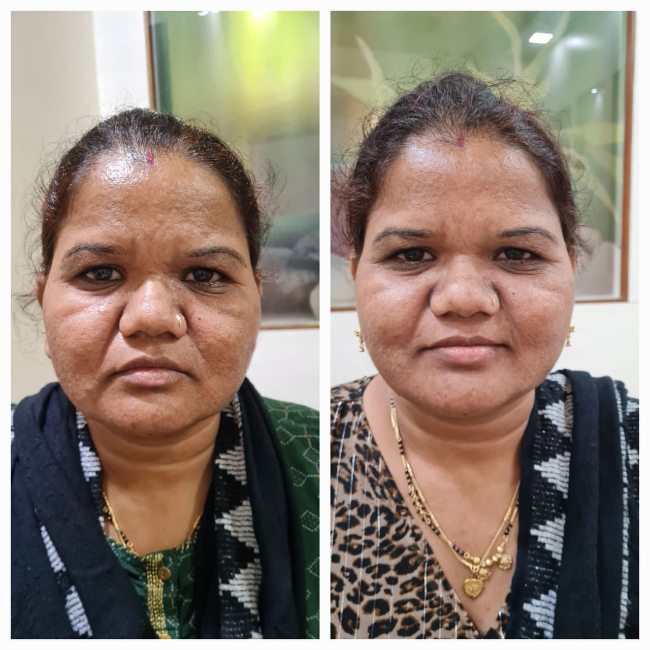 dermatologist doctors In Phursungi, Hadapsar, Manjari | hair loss ...