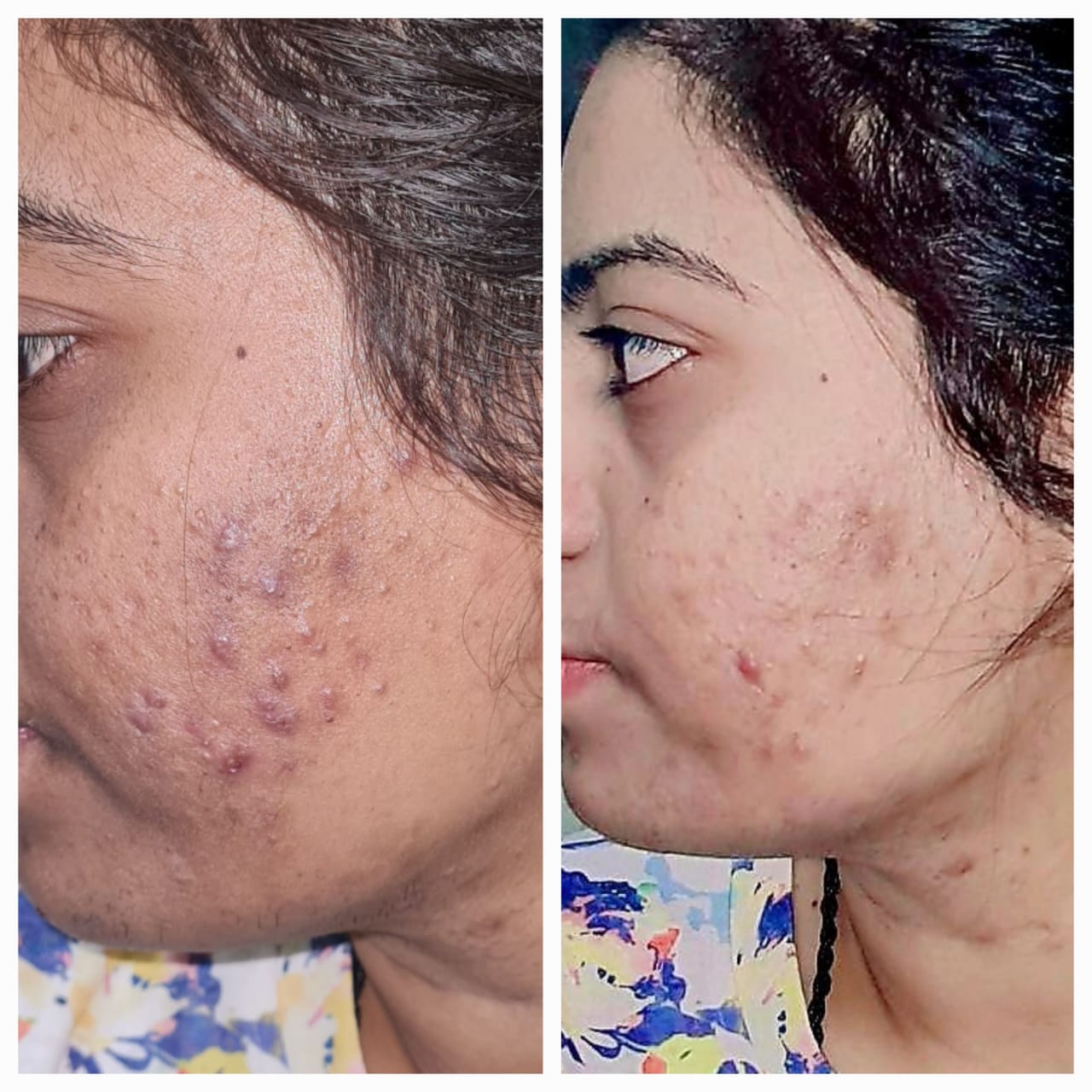 dermatologist doctors In Phursungi, Hadapsar, Manjari | hair loss ...